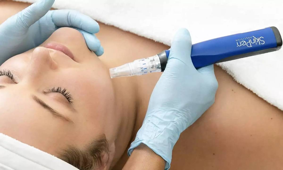 Microneedling Treatments Melbourne | Procosmetic